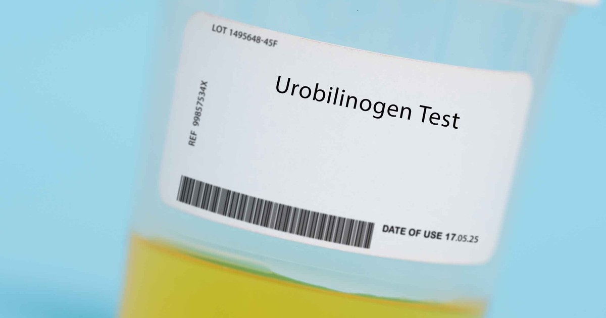 Mit jelent az urobilinogén (UBG) érték a laborleleten? | EgészségKalauz