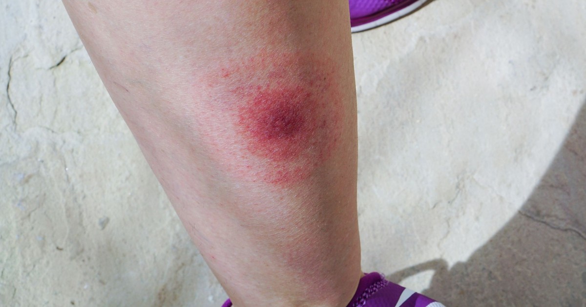 Így kezelhető a Lyme-kór különböző stádiumokban | EgészségKalauz