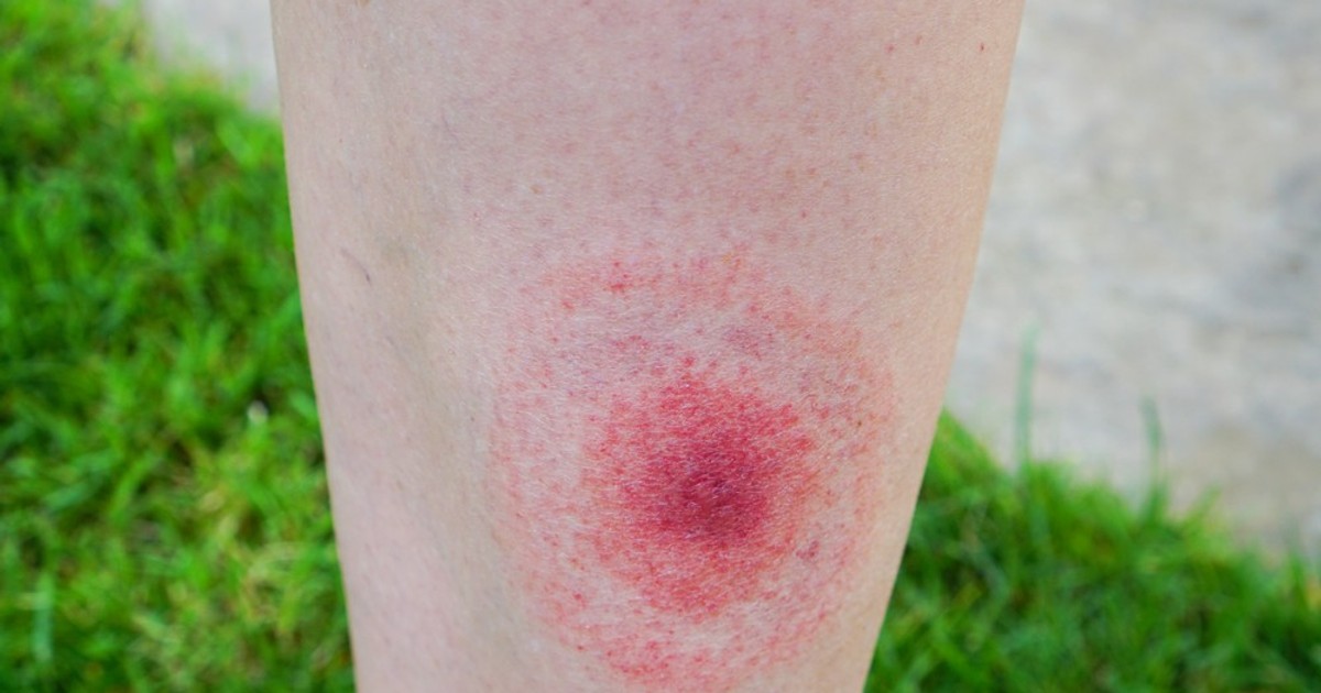 Lyme-kór: oka, tünetei és kezelése | EgészségKalauz